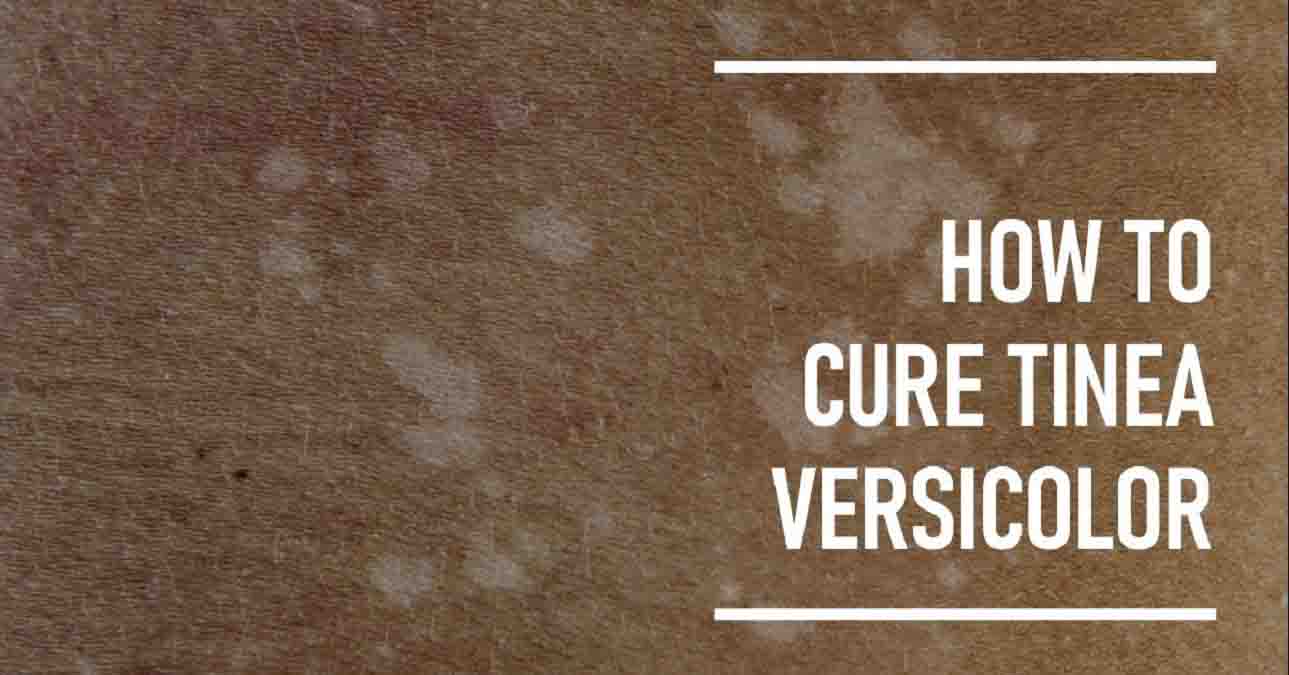 An An How To Cure - How To Cure Tinea Versicolor For Good: Unlock The ...