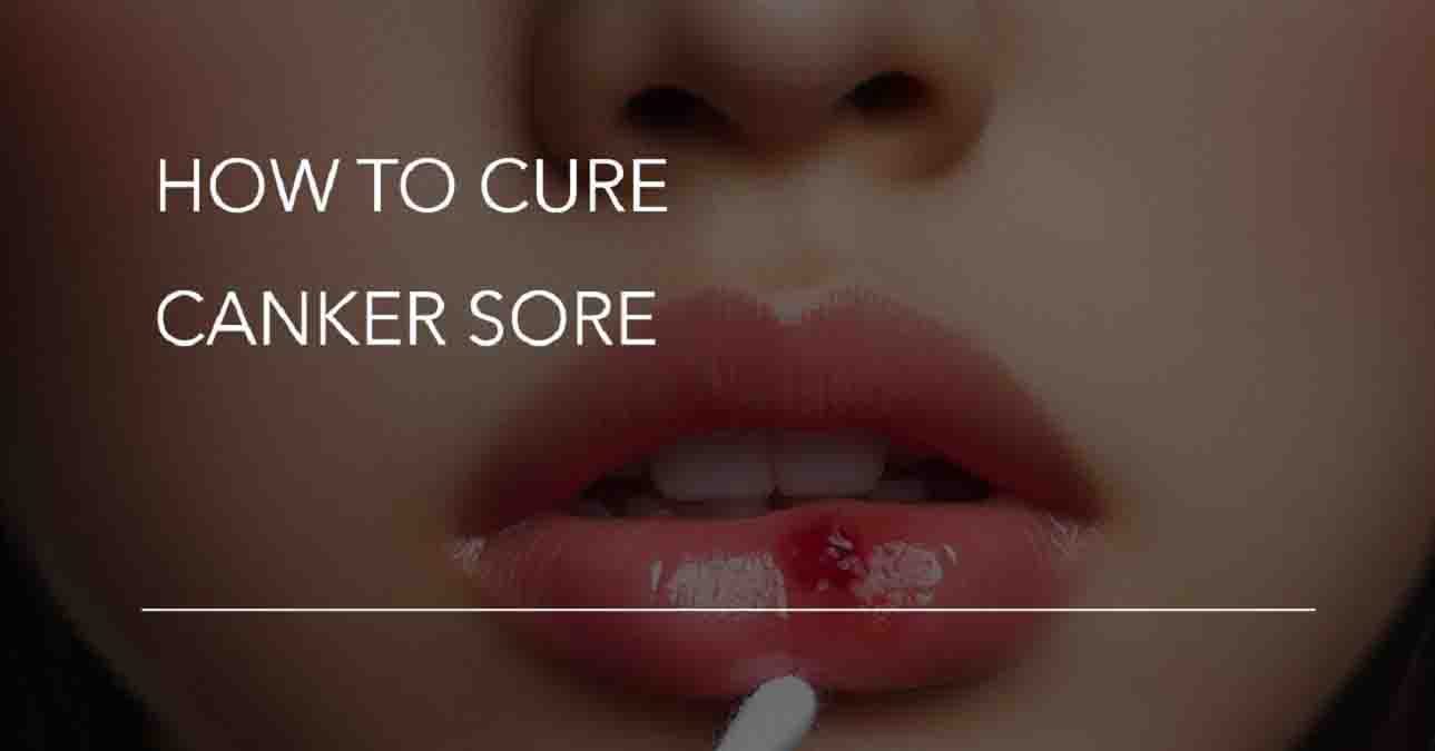 How To Cure Canker Sore: 8 Fast Relief Methods That Work