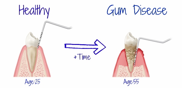 How To Grow Back Your Receding Gum With Waterpik
