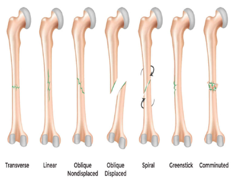 Empower Yourself: Overcoming Greenstick Fractures With Expert Advice ...