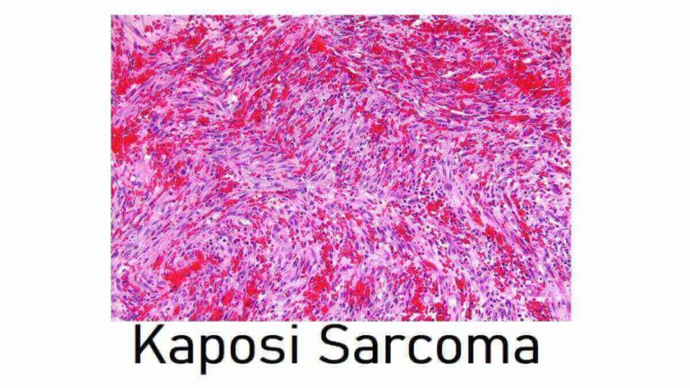 Kaposi Sarcoma: Definition, 4 Types, And Symptoms
