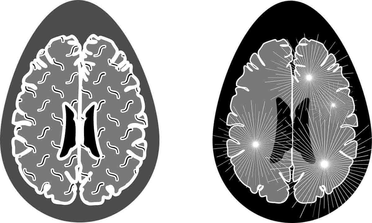 Toxoplasmosis Brain: Causes, Symptoms, Diagnosis, And Treatment » 2025