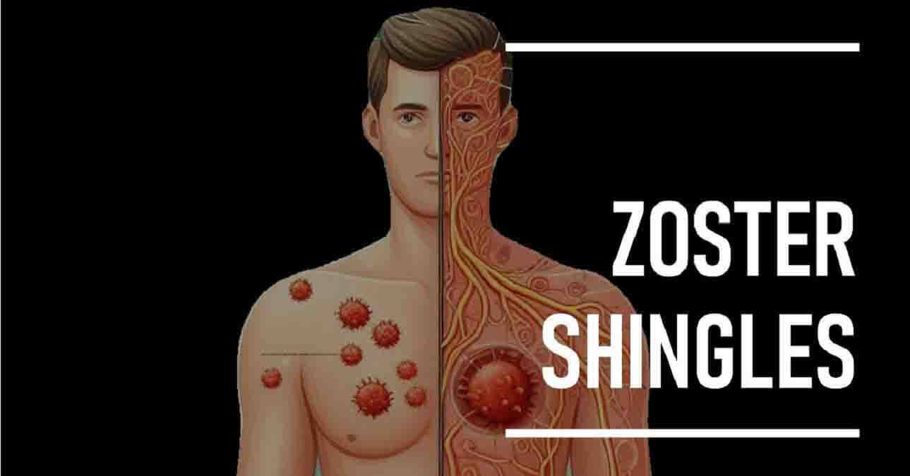 Zoster Shingles: The Silent Agony Unmasked » 2025